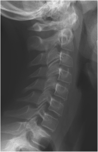 Radiographic morphology of normal ring apophyses in the immature ...