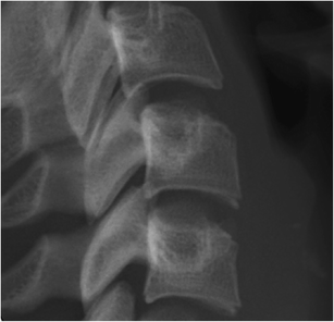 Radiographic morphology of normal ring apophyses in the immature ...