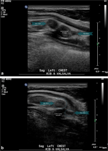 Dynamic ultrasound in the evaluation of patients with suspected ...