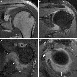 Adhesive capsulitis: review of imaging findings, pathophysiology ...