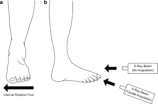 Influence of the ankle position and X-ray beam angulation on the ...