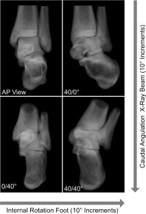 Influence of the ankle position and X-ray beam angulation on the ...