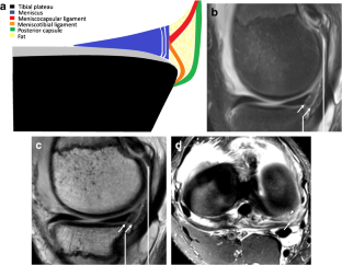 MRI appearance of the different meniscal ramp lesion types, with ...
