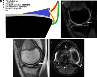 MRI appearance of the different meniscal ramp lesion types, with ...