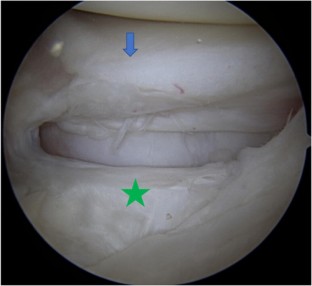 MRI appearance of the different meniscal ramp lesion types, with ...