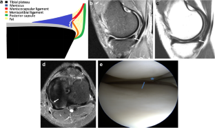 MRI appearance of the different meniscal ramp lesion types, with ...