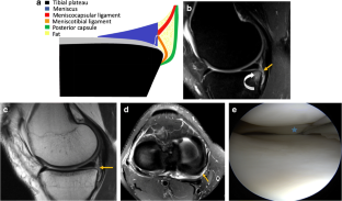 MRI appearance of the different meniscal ramp lesion types, with ...