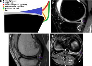 MRI appearance of the different meniscal ramp lesion types, with ...
