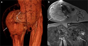 Pelvic bone tumor resection: what a radiologist needs to know ...