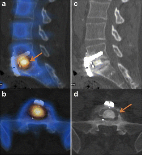 Bone SPECT/CT in the postoperative spine: a focus on spinal fusion ...