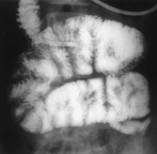 Small bowel tuberculosis | SpringerLink