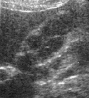 Multiseptate gallbladder: diagnostic value of MR cholangiography and ...