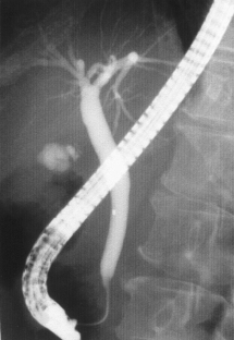 Multiseptate gallbladder: diagnostic value of MR cholangiography and ...