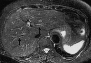 MRI findings of primary biliary cirrhosis: correlation with Scheuer ...