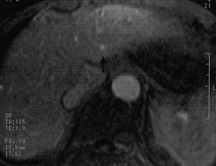 MRI findings of primary biliary cirrhosis: correlation with Scheuer ...
