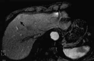 MRI findings of primary biliary cirrhosis: correlation with Scheuer ...