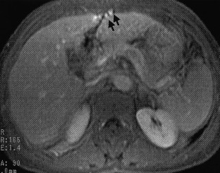 MRI findings of primary biliary cirrhosis: correlation with Scheuer ...