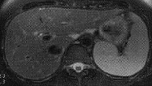 MRI findings of primary biliary cirrhosis: correlation with Scheuer ...