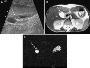 Gallbladder adenomyomatosis: imaging findings | SpringerLink