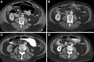 Omental infarct: CT imaging features | SpringerLink