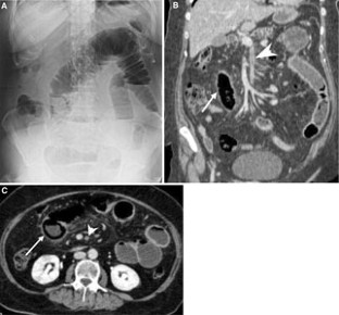 Ischemia and infarction of the small bowel and colon: spectrum of ...