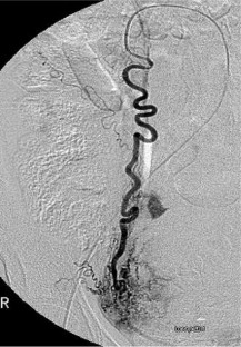 Update on uterine artery embolization for symptomatic fibroid disease ...