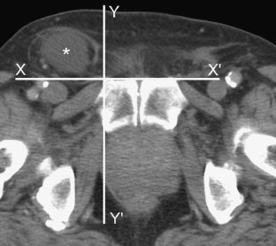 The pubic tubercle: a CT landmark in groin hernia | SpringerLink