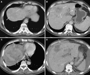 The various manifestations of ruptured hepatocellular carcinoma: CT ...