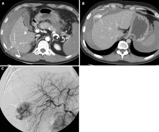 The various manifestations of ruptured hepatocellular carcinoma: CT ...