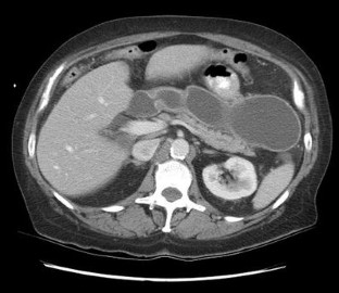 Partial small bowel obstruction: clinical issues and recent technical ...