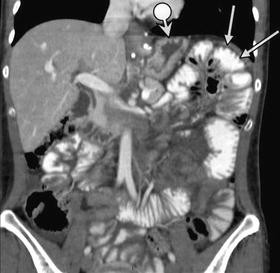 Petersen’s hernia as a complication of bariatric surgery: CT findings ...