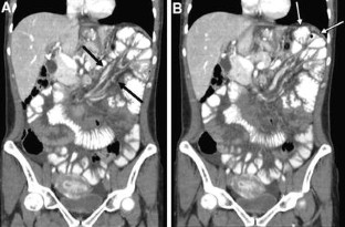 Petersen’s hernia as a complication of bariatric surgery: CT findings ...