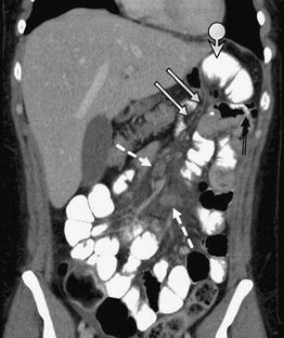 Petersen’s hernia as a complication of bariatric surgery: CT findings ...