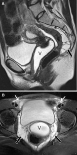 Benign and malignant tumors of the rectum and perirectal region ...
