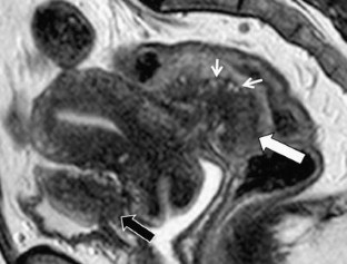 Benign and malignant tumors of the rectum and perirectal region ...