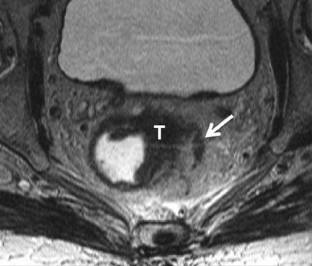 Benign and malignant tumors of the rectum and perirectal region ...