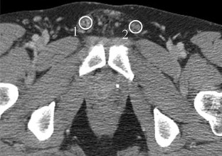 Asymmetric spermatic cord vessel enhancement on CT: a sign of ...