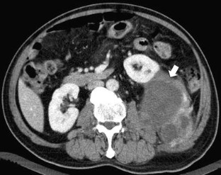 Primary retroperitoneal masses: what is the differential diagnosis ...