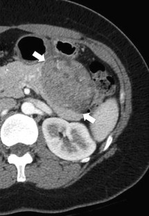 Primary retroperitoneal masses: what is the differential diagnosis ...