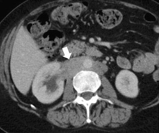 Primary retroperitoneal masses: what is the differential diagnosis ...