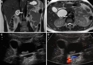 Imaging of choledochal cysts | SpringerLink