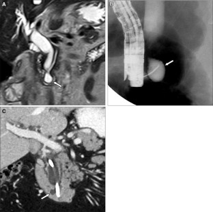 Imaging of choledochal cysts | SpringerLink