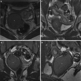 Herlyn–Werner–Wunderlich syndrome: pre- and post-surgical MRI and US ...