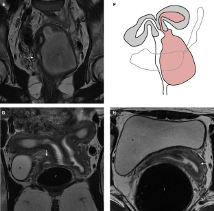 Herlyn–Werner–Wunderlich syndrome: pre- and post-surgical MRI and US ...