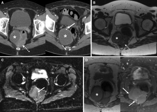 Imaging of tailgut cysts | SpringerLink