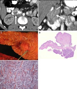 MDCT and MRI of the ampulla of Vater (part I): technique optimization ...