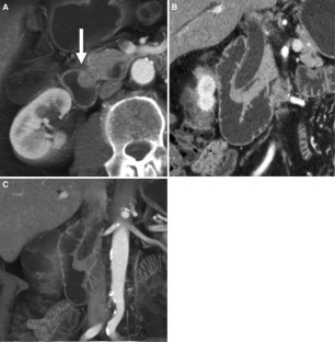MDCT and MRI of the ampulla of Vater (part I): technique optimization ...