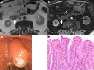 MDCT and MRI of the ampulla of Vater (part I): technique optimization ...