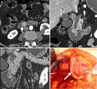 MDCT and MRI of the ampulla of Vater (part I): technique optimization ...
