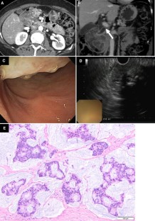 MDCT and MRI of the ampulla of Vater (part I): technique optimization ...